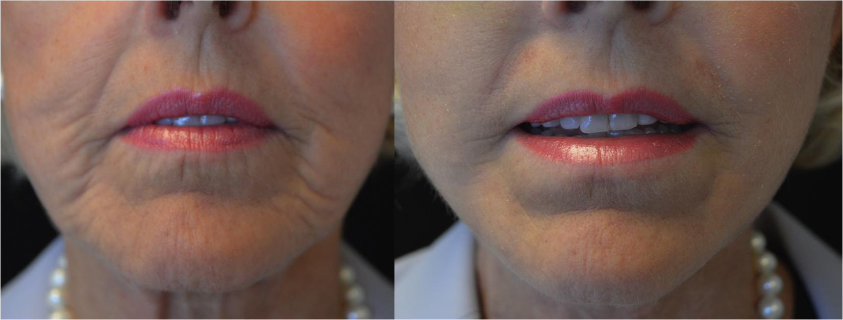 Before and After Fat Grafting to Perioral Lines – BuildMyHealth