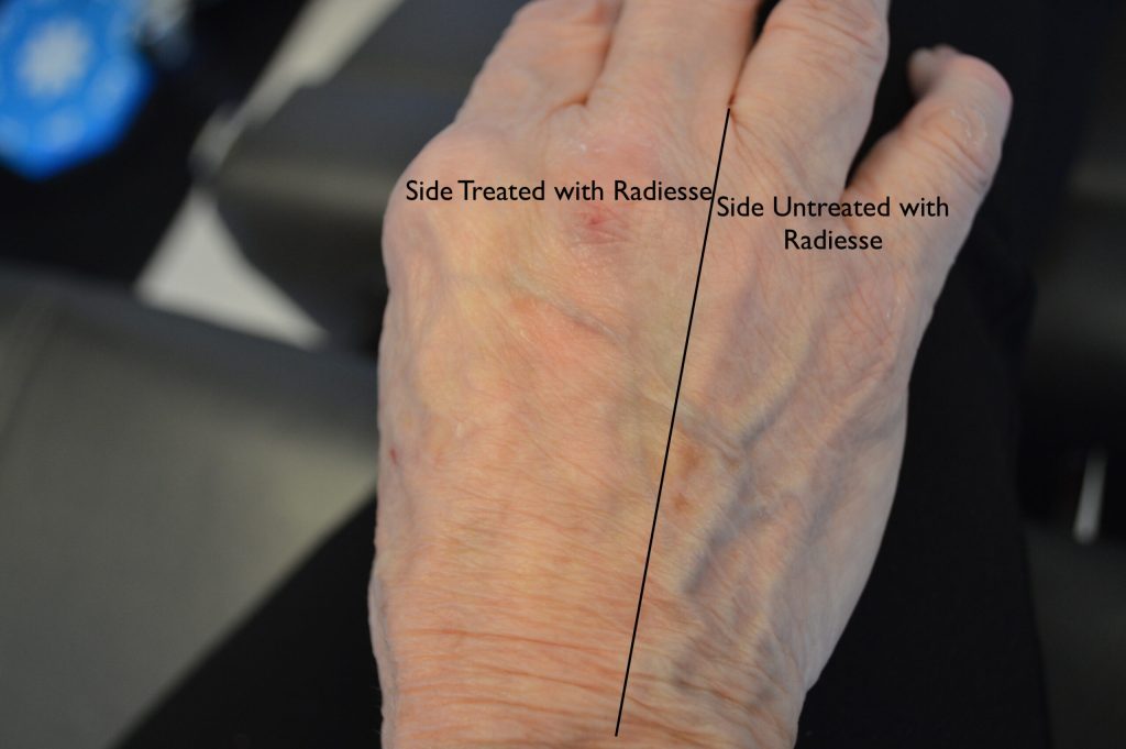 Treated and untreated R hand comparison – BuildMyHealth