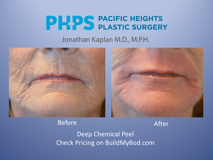 Skin resurfacing with a deep chemical peel to remove wrinkles ...