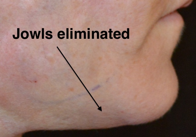 Full vs Mini tummy tuck, necklift and facelift – BuildMyHealth