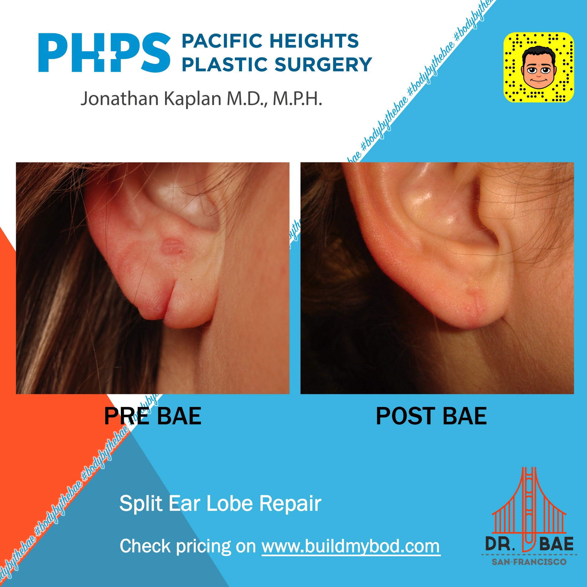 Before and After – Split Ear Lobe Repair – BuildMyHealth